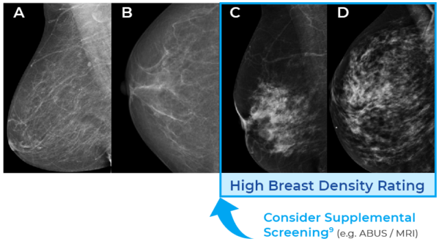 AI Breast Density Assessment | iCAD
