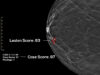 AI Breast Cancer Detection | iCAD