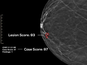 AI Breast Cancer Detection | iCAD