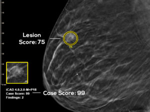 AI Breast Cancer Detection | iCAD